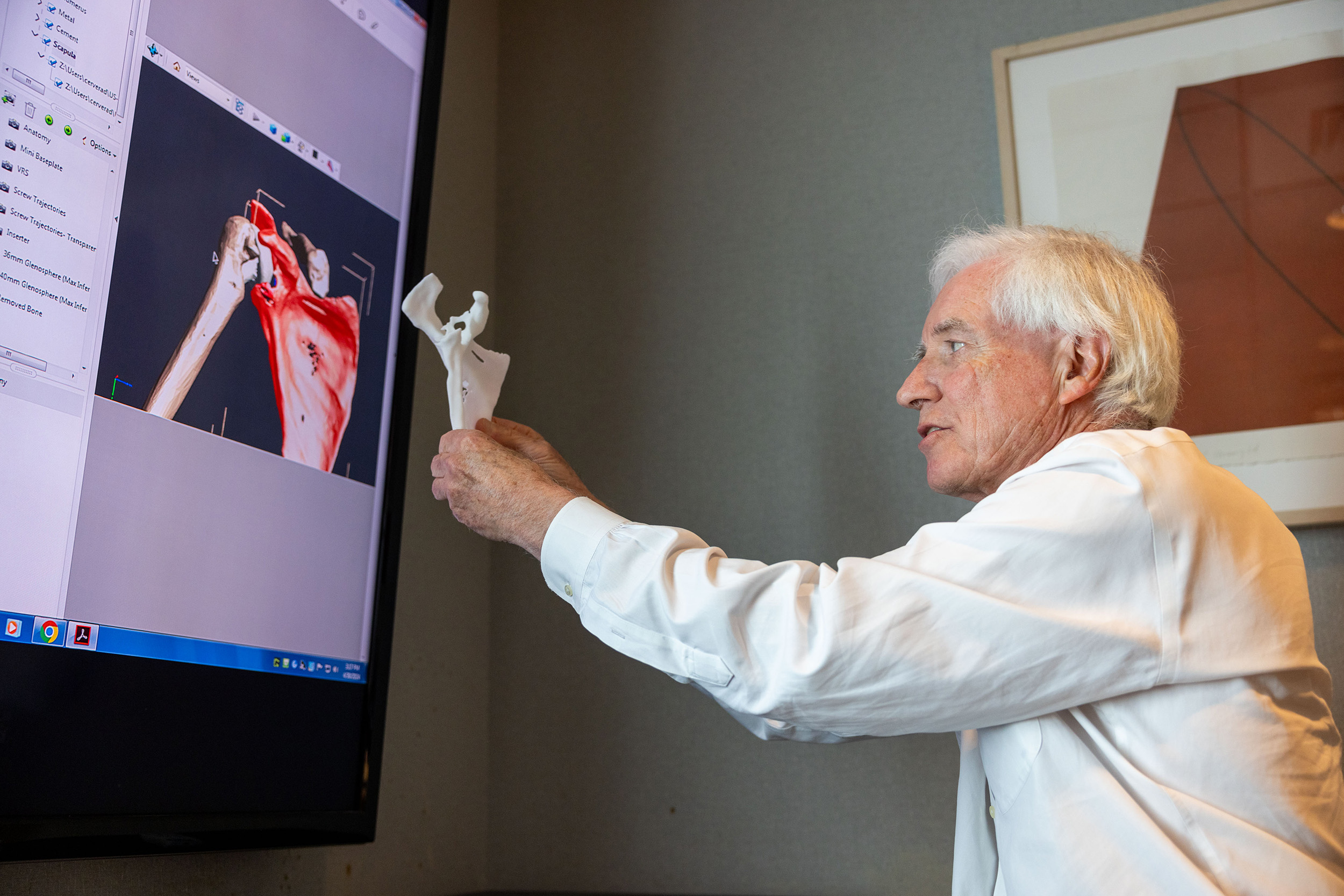 Treating shoulder replacement with custom implants | University of Iowa ...