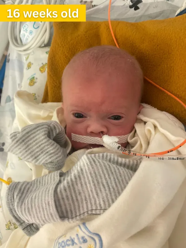Iowa boy born at 21 weeks is now the world's most premature baby ...
