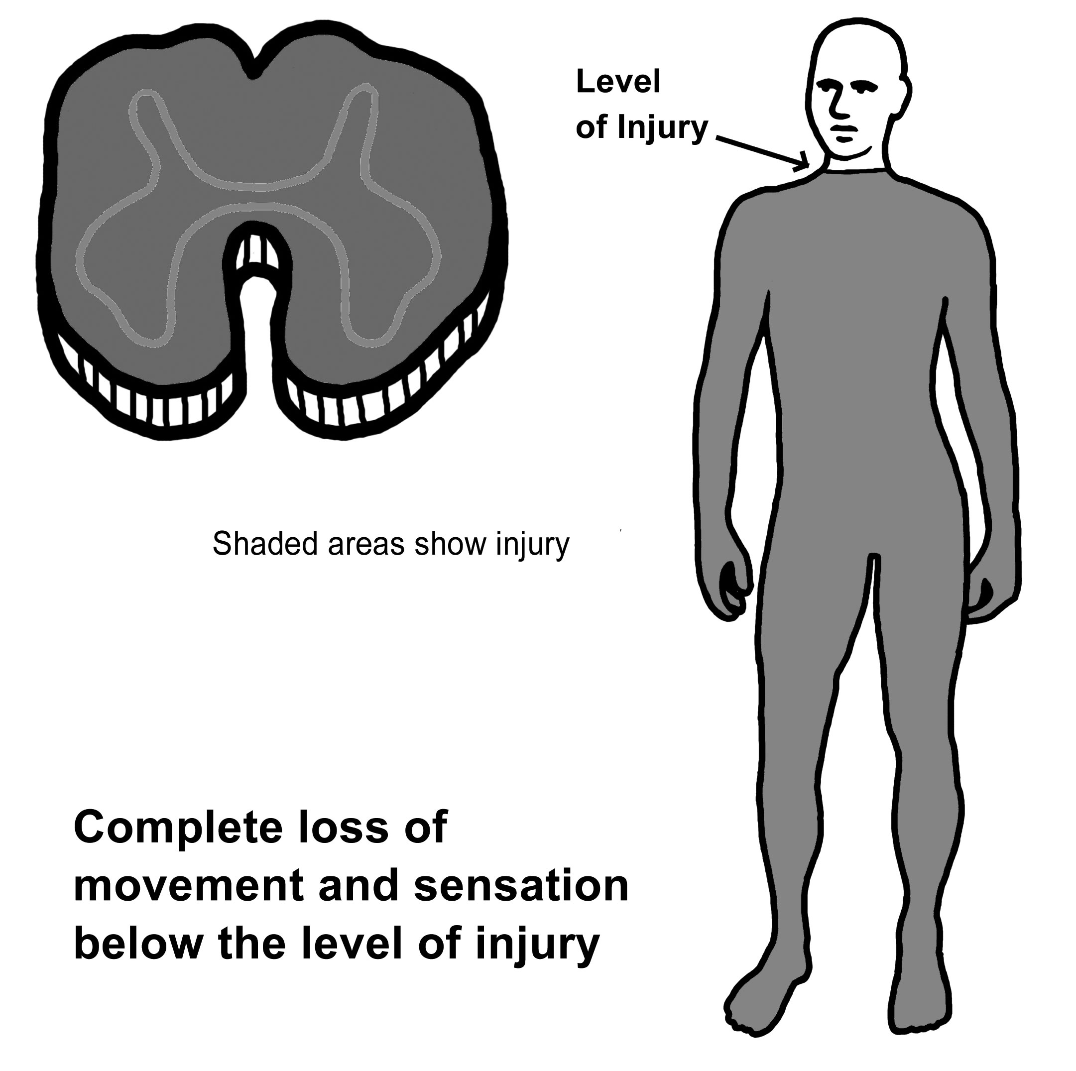 What Happens To The Spinal Cord University Of Iowa Hospitals Clinics What Happens To The Spinal Cord University Of Iowa Hospitals Clinics