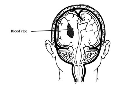 Blood Clot In Brain Due To Accident